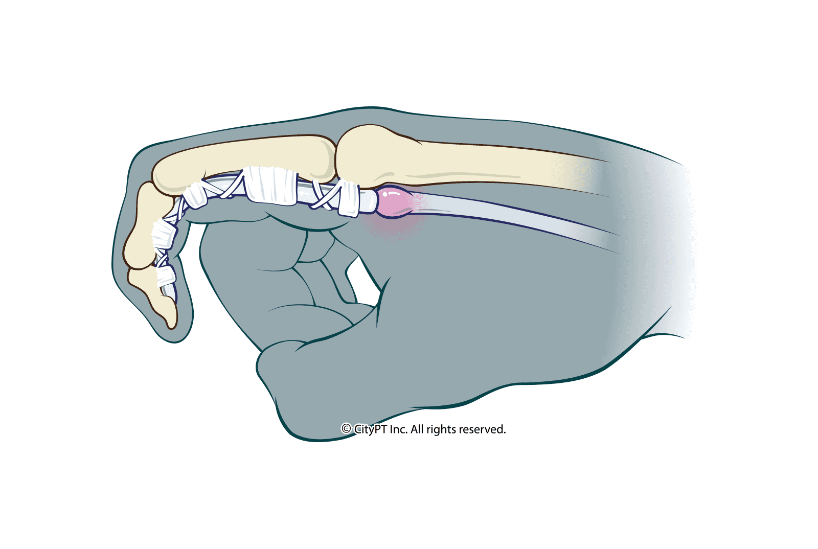 An Occupational Therapy Guide to Trigger Finger - CityPT