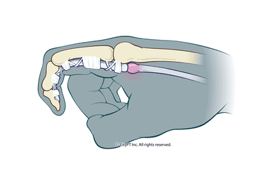 An Occupational Therapy Guide to Trigger Finger - CityPT